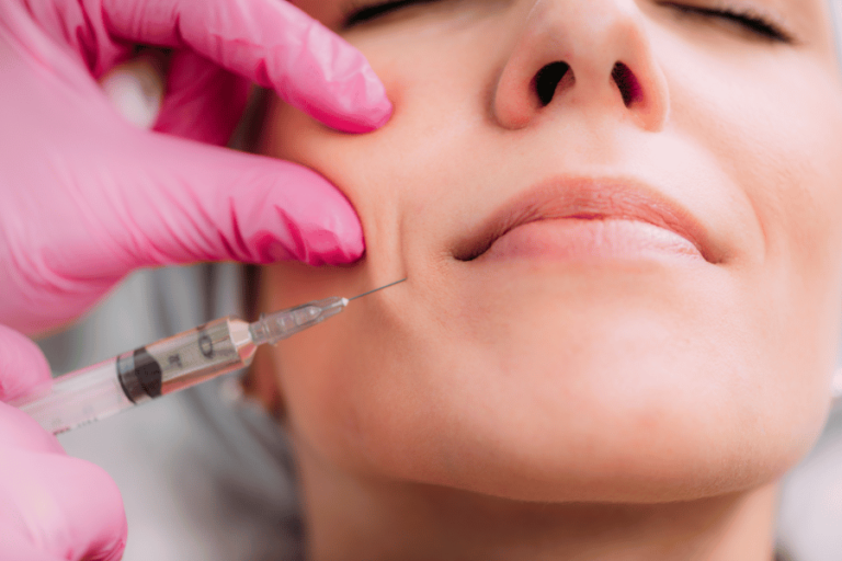 Perioral Mounds - Skinspire Laser&Skin Clinic