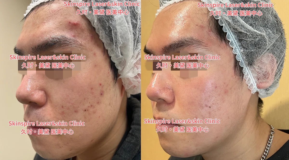 RF Microneedling - Skinspire Laser&Skin Clinic