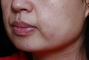 Perioral Mounds - Skinspire Laser&Skin Clinic