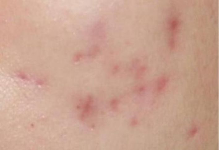 Acne Marks - Skinspire Laser&Skin Clinic