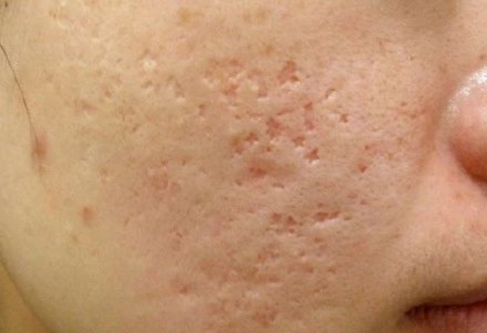 Acne Scars - Skinspire Laser&Skin Clinic