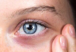 Dark Circles Under Eyes / Tear Troughs - Skinspire Laser&Skin Clinic