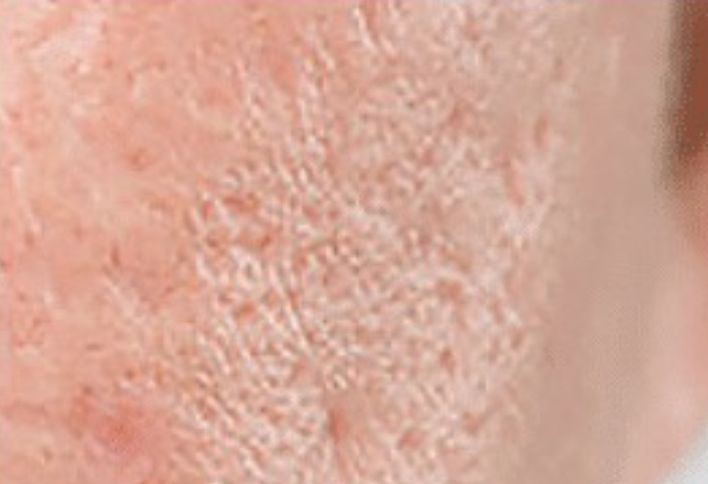 Acne Scars - Skinspire Laser&Skin Clinic