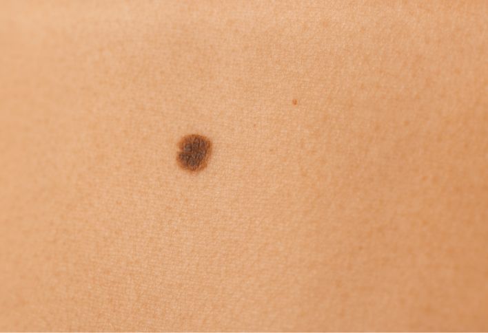 Mole - Skinspire Laser&Skin Clinic