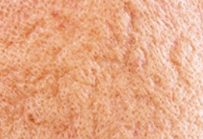 Acne Scars - Skinspire Laser&Skin Clinic