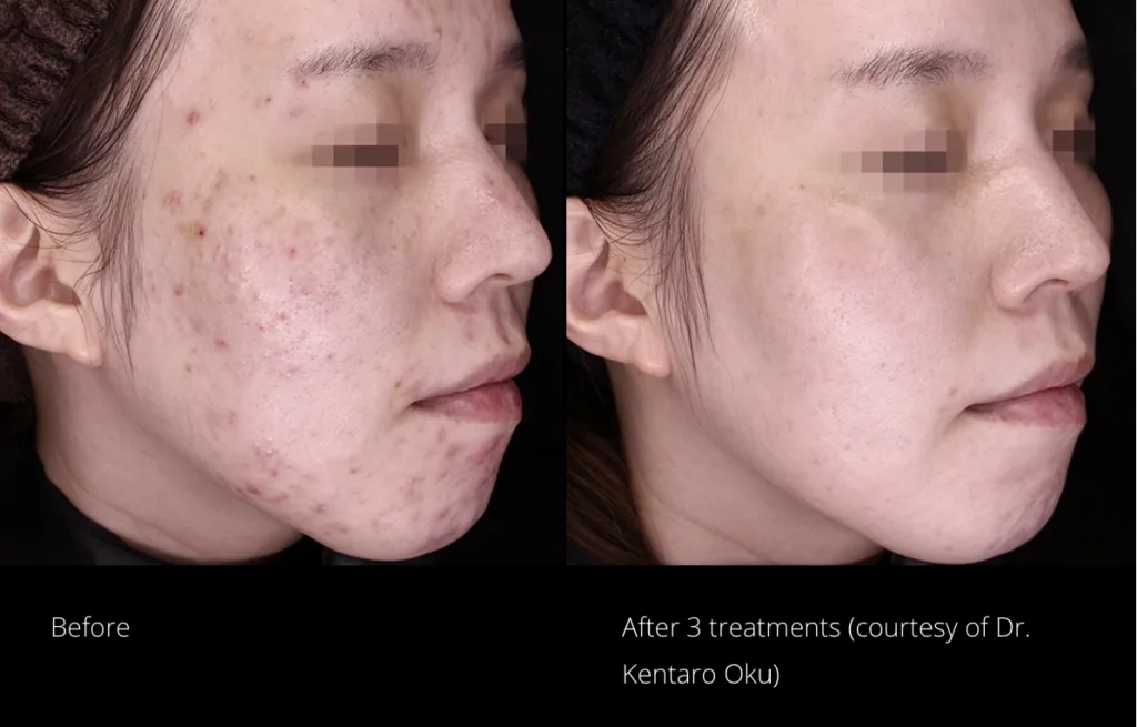 🌟 PicoSure vs. PicoSure Pro: What’s the Difference? - Skinspire Laser ...