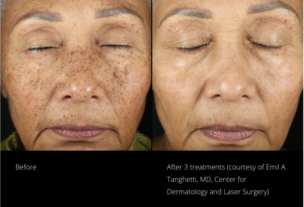 🌟 PicoSure vs. PicoSure Pro: What’s the Difference? - Skinspire Laser ...
